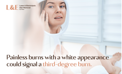 Laser Burn Treatment at Home: Tips & Natural Remedies