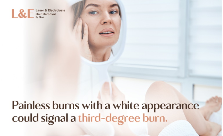 Laser Burn Treatment at Home: Tips & Natural Remedies